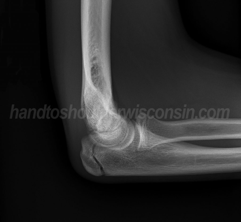 Hand to Shoulder Center of Wisconsin | Elbow Fracture